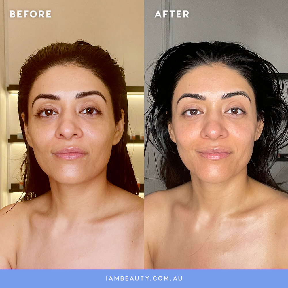 Lymphatic & Buccal Facial Massage - Before and After photos