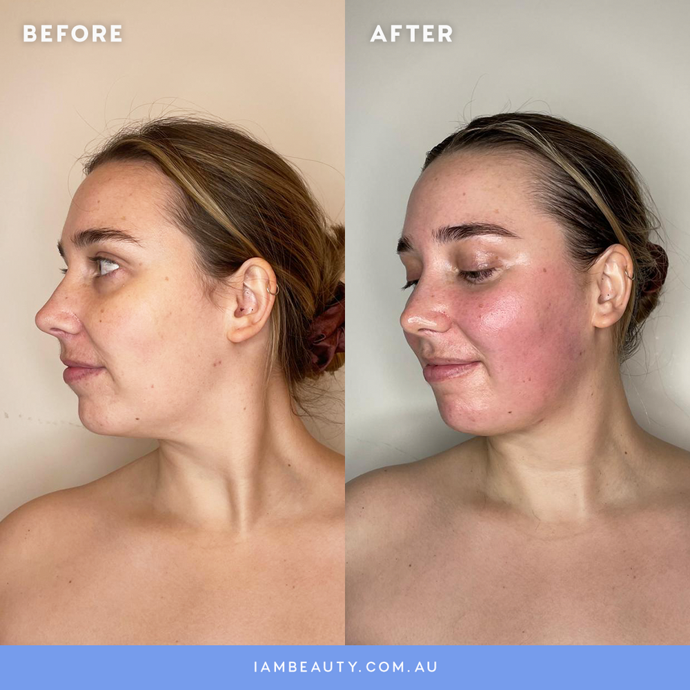 Buccal Massage | Before and After Photos | I Am Beauty