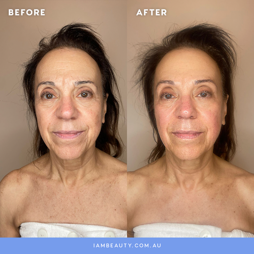 Buccal Massage | Before and After Photos | I Am Beauty