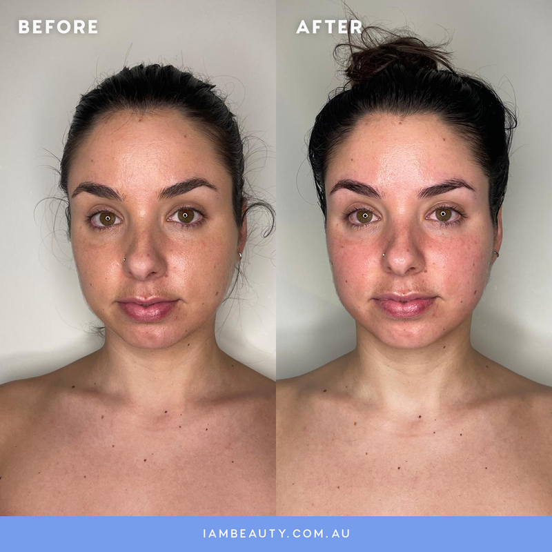 Buccal Massage | Before and After Photos | I Am Beauty