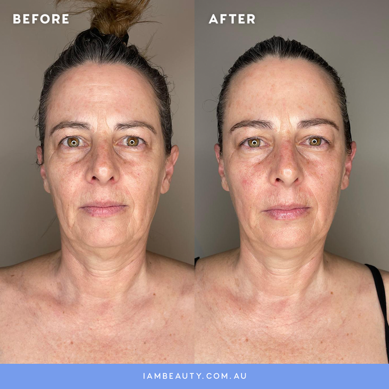 Buccal Massage | Before and After Photos | I Am Beauty