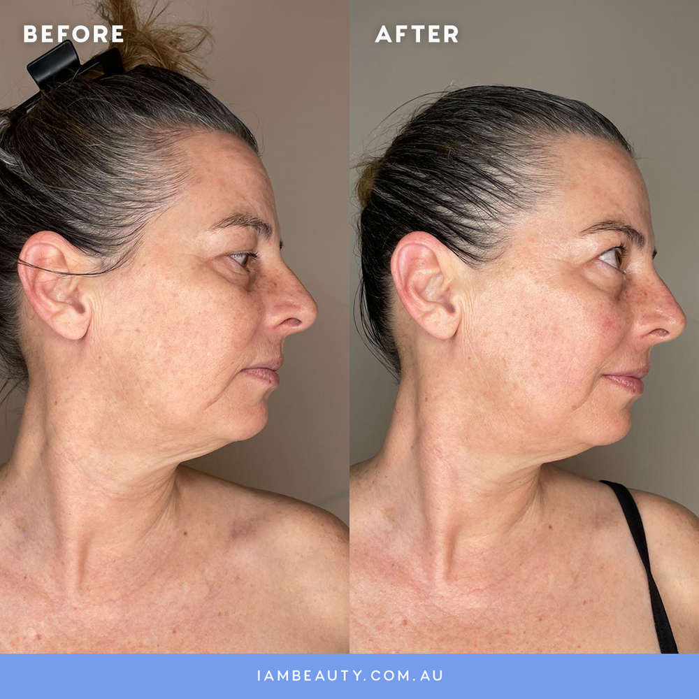 Lymphatic & Buccal Facial Massage - Before and After photos