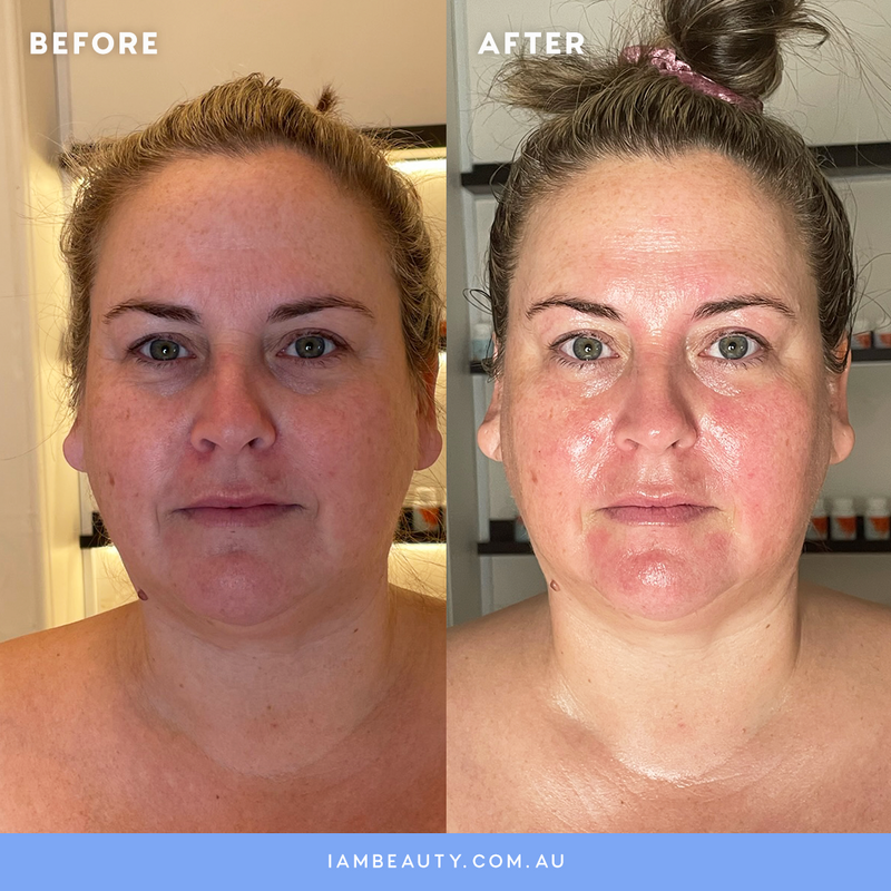 Lymphatic & Buccal Facial Massage - Before and After photos