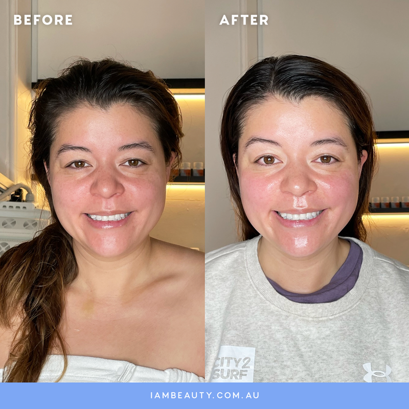 Lymphatic & Buccal Facial Massage - Before and After photos